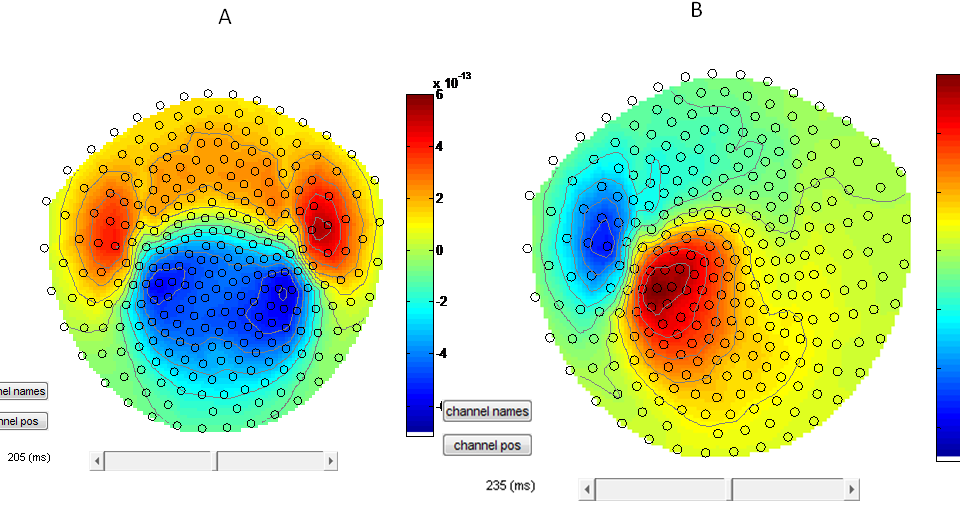 GitHub - FarkadAdnan/Statistical-Parametric-Mapping: The FIL Methods Group