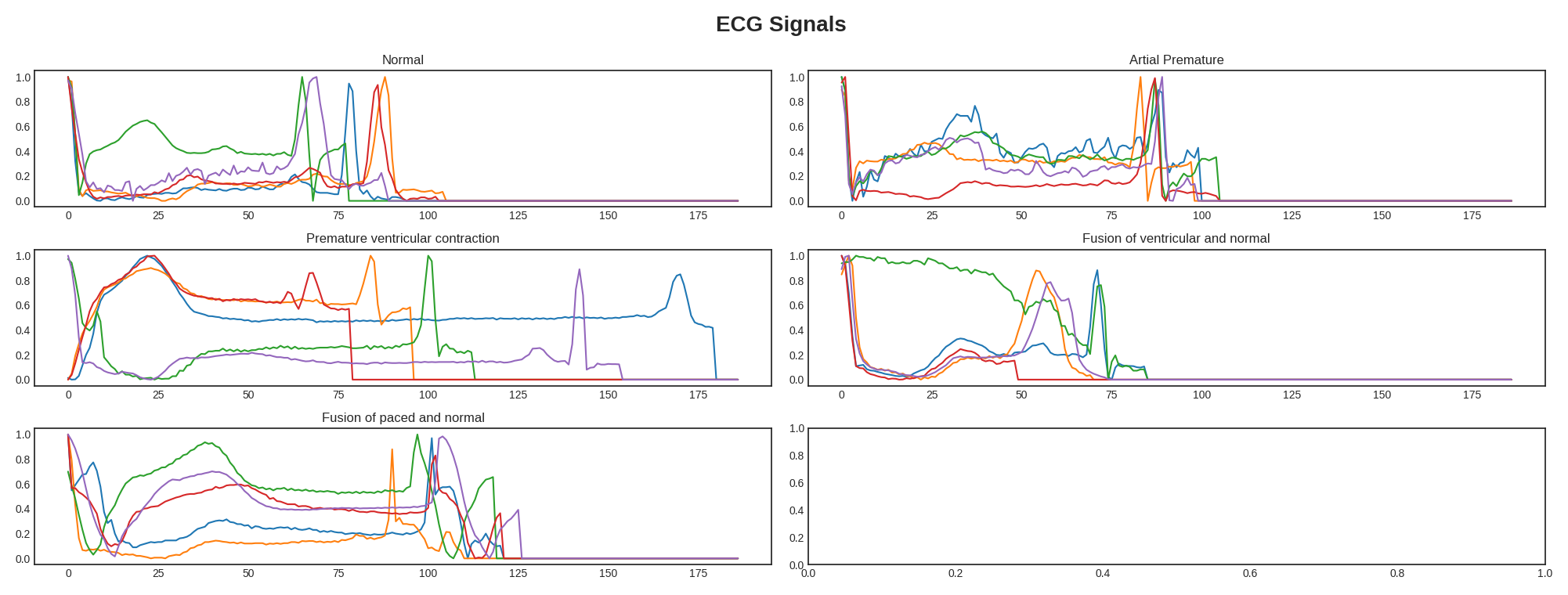 GitHub - WoodoLee/ecg_stage: ecg stage classification