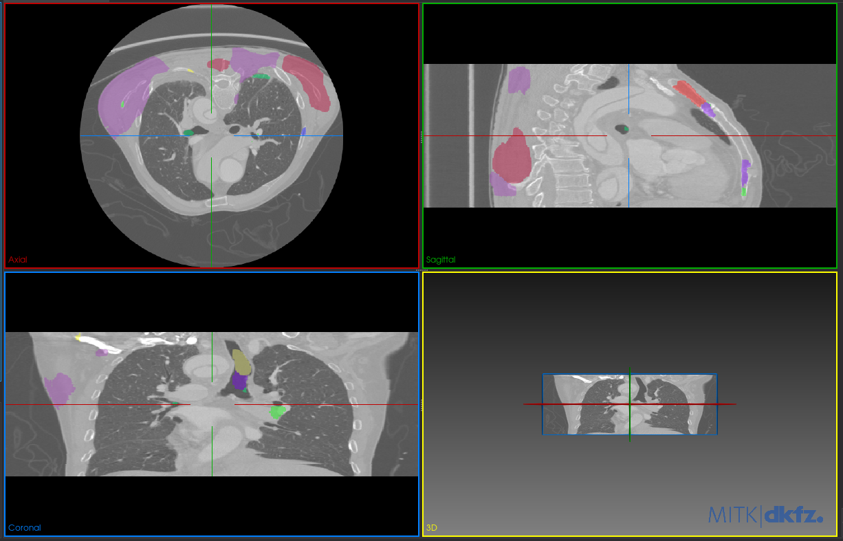 poor segmentation results · Issue #78 · wasserth/TotalSegmentator · GitHub