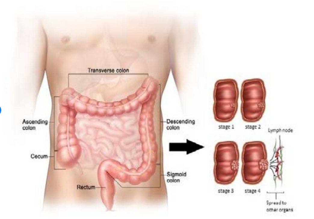 Gapminder Colon cancer | Kaggle