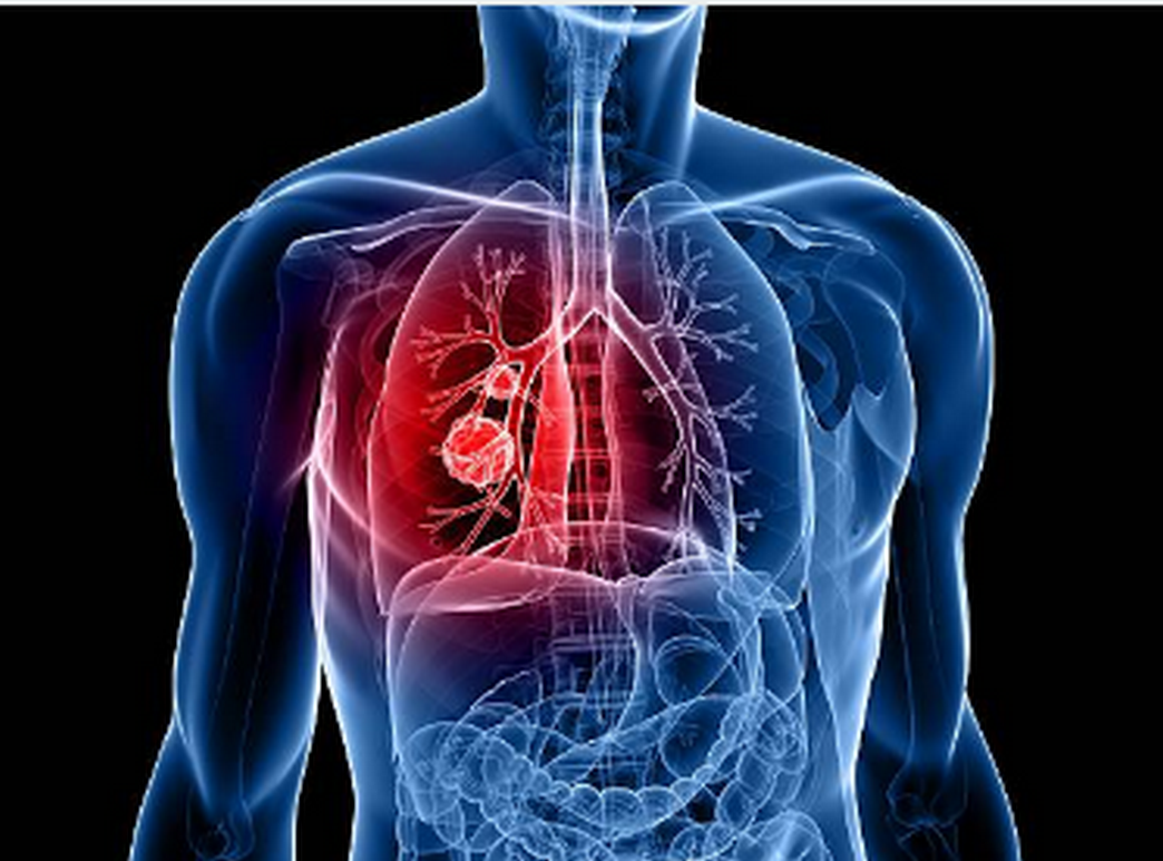 Lung Cancer | Kaggle