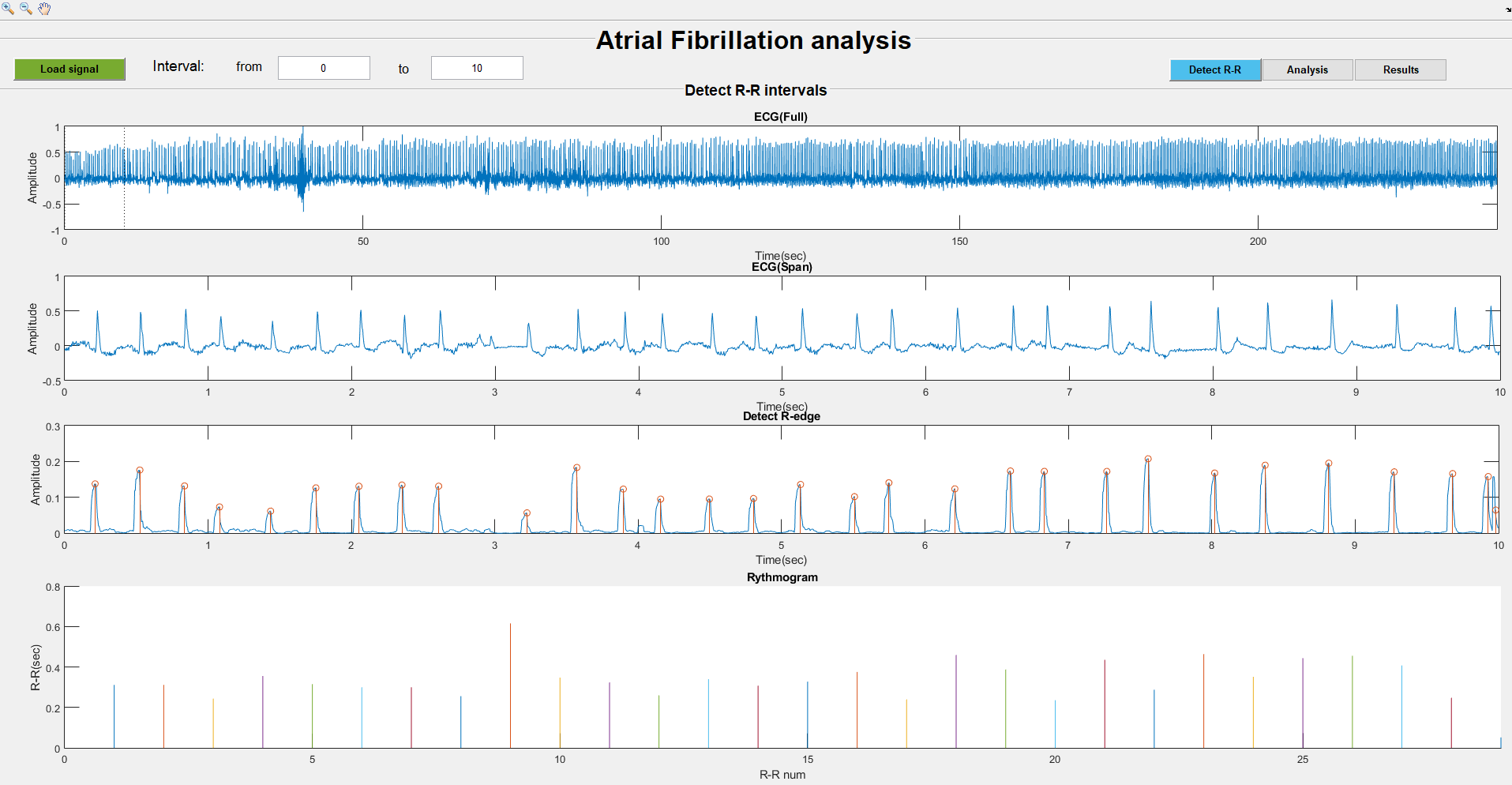 GitHub - EldarShayahmetov/Atrial-fibrillation-analysis: Atrial fibrillation analysis program ...