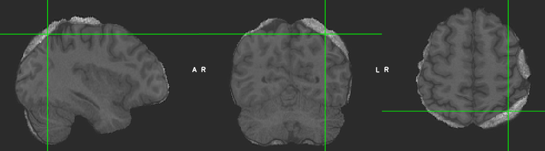 ANTs skull stripping includes dura mater · Issue #716 · ANTsX/ANTs · GitHub