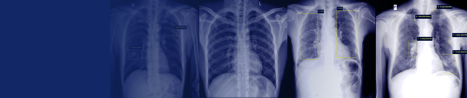 GitHub - awsaf49/vinbigdata-cxr-abnormalities-detection: VinBigData Chest X-ray Abnormalities ...