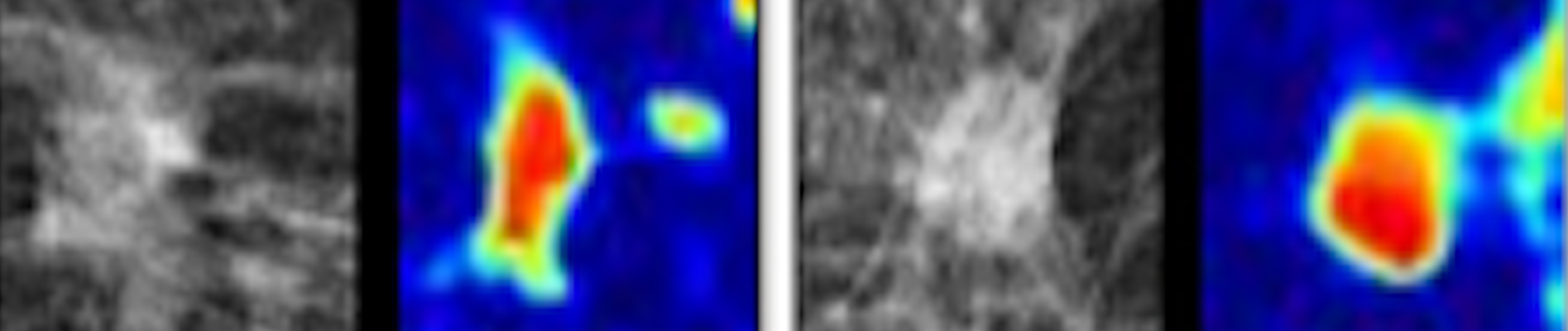 GitHub - awsaf49/rsna-breast-cancer-detection: RSNA Screening Mammography Breast Cancer ...