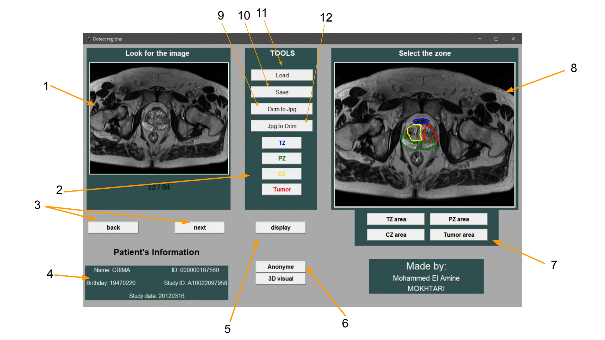 GitHub - amine0110/Manual-tumor-segmentation