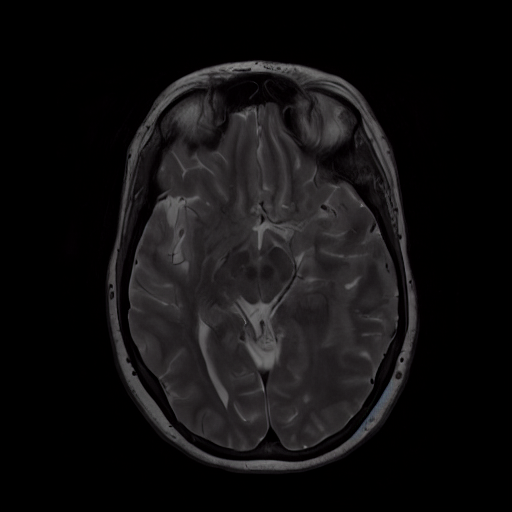 GitHub - kbressem/object-removal: Object removal with stable diffusion for radiological images
