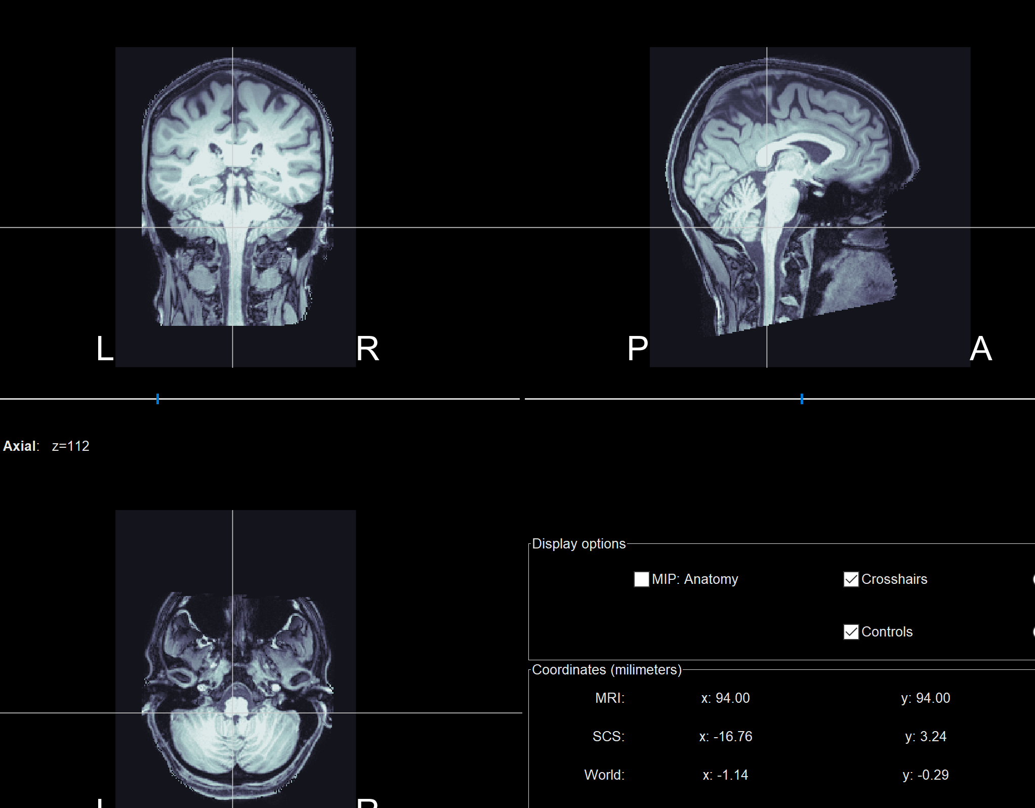 new method for defacing MRI (3D and 4D volume) · Issue #307 ...