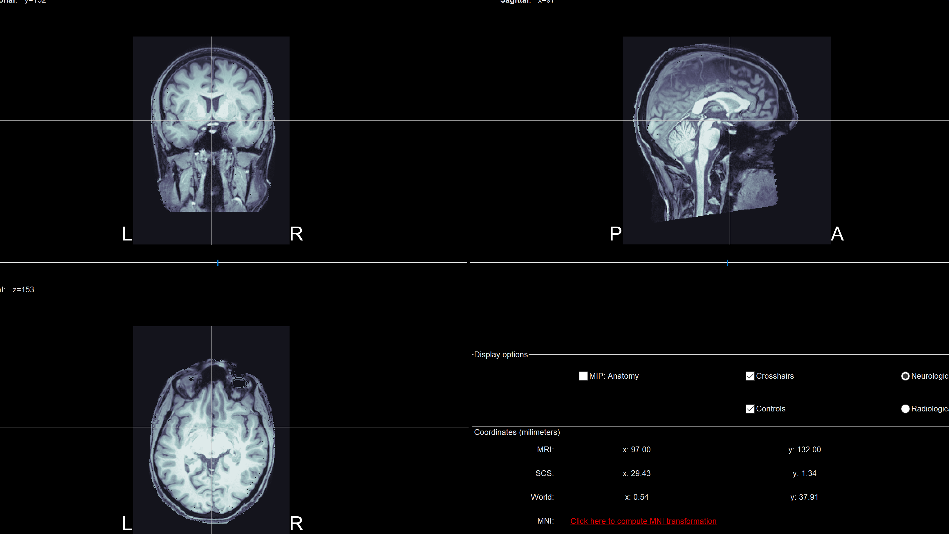 new method for defacing MRI (3D and 4D volume) · Issue #307 ...