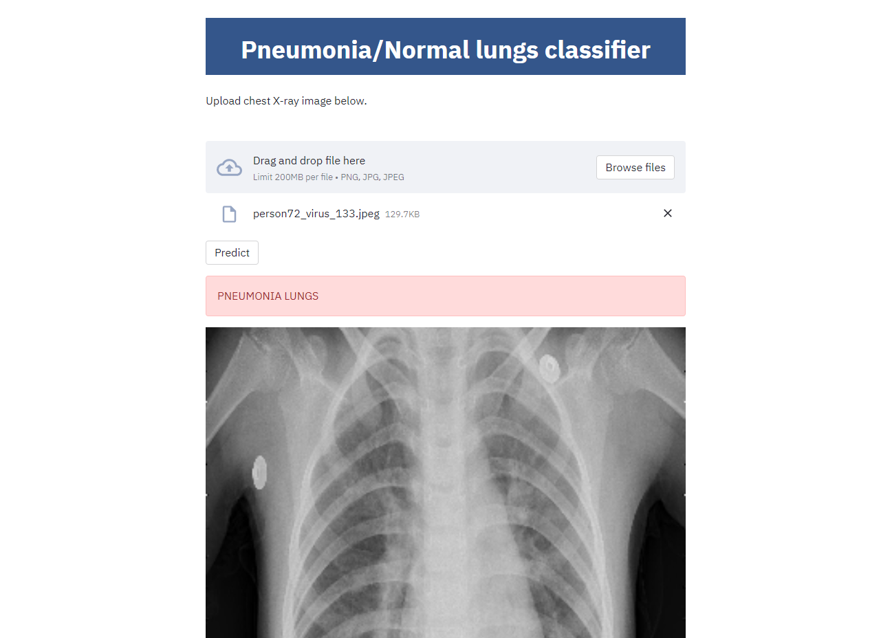 GitHub - VaisakNair7/Pneumonia-Chest-X-ray-Classification-using ...