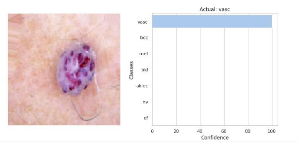 GitHub - singhn156/Skin_Cancer_Image_Classification: Objective is to ...