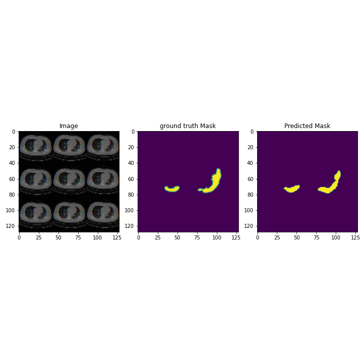 GitHub - zihad-13/Segmentation-model-for-CT-scan-lesion: Kaggle-COVID-19 CT scan lesion ...