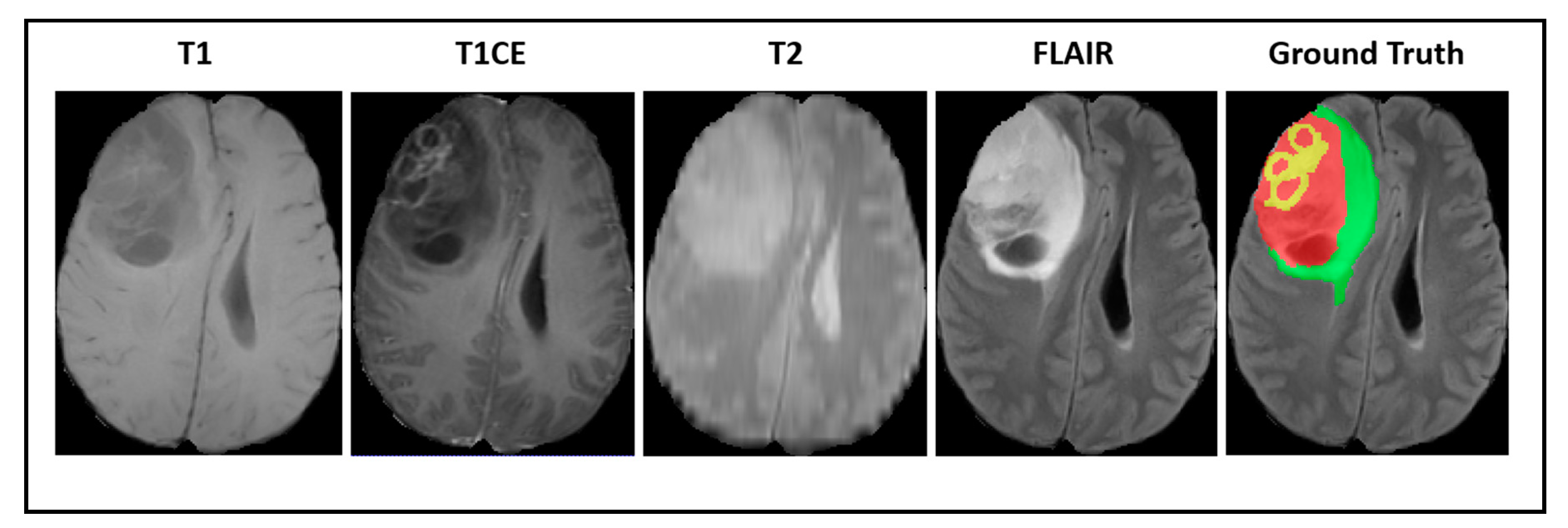 Github Alimpan Ml Project Brain Tumor Segmentation