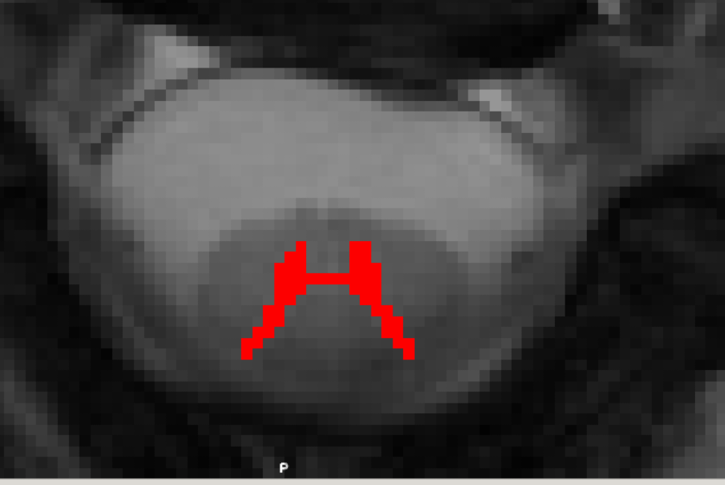 Discrepancy between QC output and real segmentation · Issue #3406 · spinalcordtoolbox ...