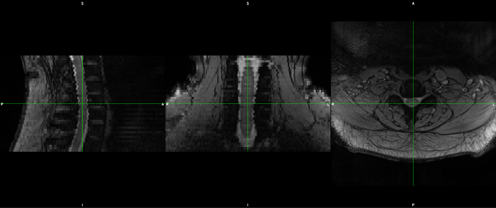 sct_deepseg_sc empty result on data after motion correction · Issue #1770 · spinalcordtoolbox ...