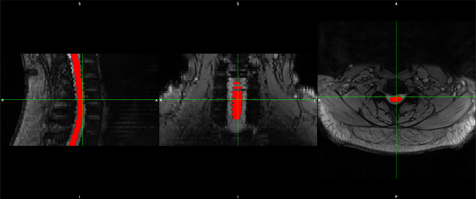 sct_deepseg_sc empty result on data after motion correction · Issue #1770 · spinalcordtoolbox ...