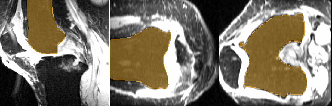 Github Brendan0403bonessegmentation Bones Segmentation By Deep Learning