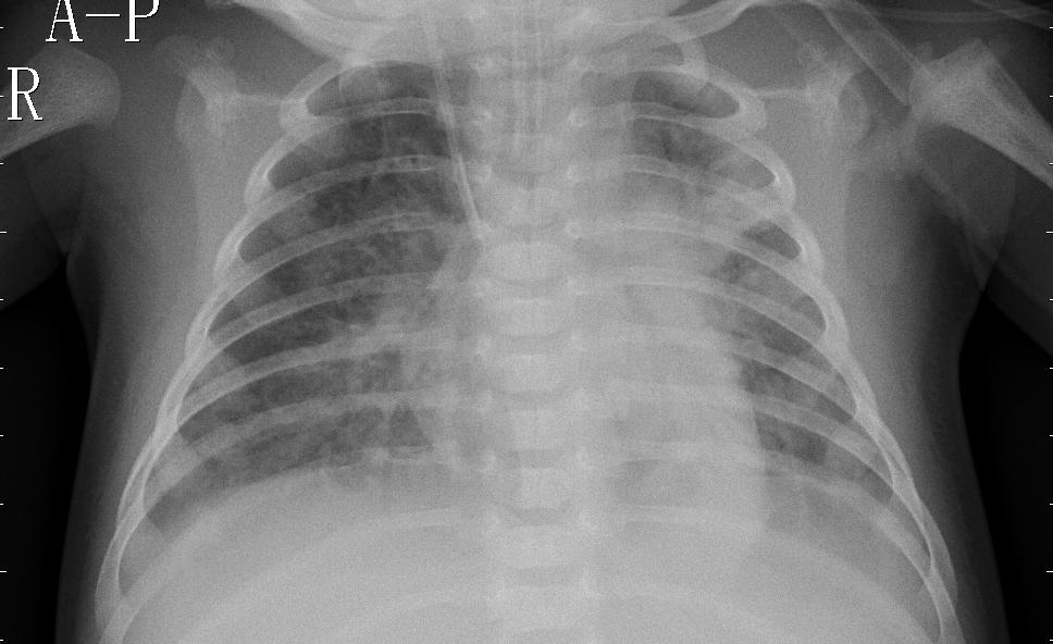 GitHub - ChanJin0801/LungDiseaseKaggle