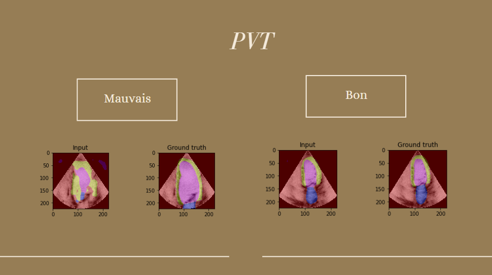 GitHub - tef76/Unet-vs-PVT-on-medical-image-segmentation: L'objectif de mon TER lors de mon ...