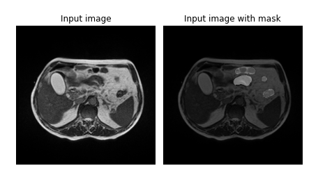 GitHub - jayicebear/cancer-segmantation