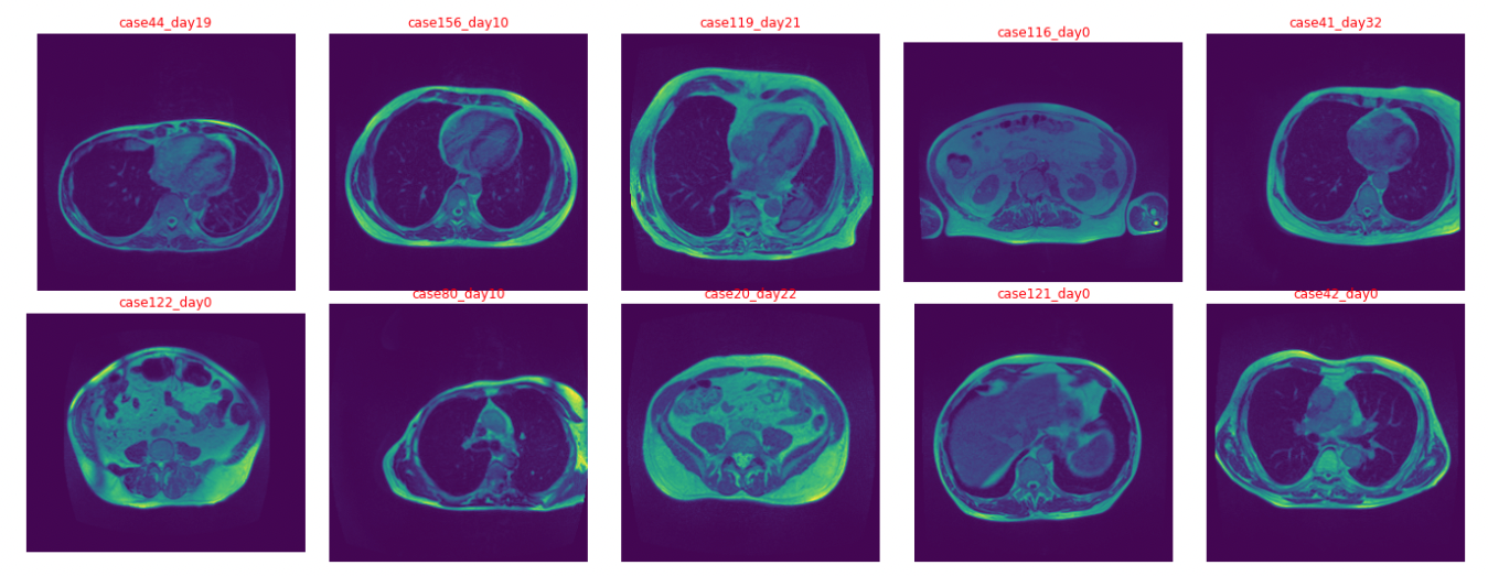 GitHub - jayicebear/cancer-segmantation