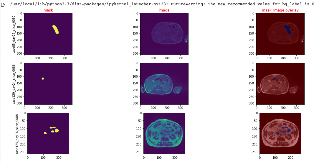 GitHub - jayicebear/cancer-segmantation