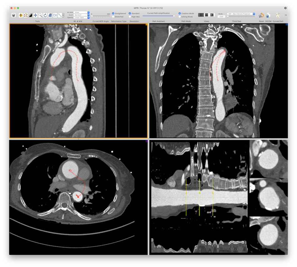 Can we obtain Curved MPR via centerline of artery from CTA? · Issue ...