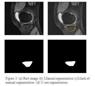 GitHub - Nilesh7889/Deep-Learning-for-Tibia-Bone-Segmentation-using-U-Net-: Trained machine ...