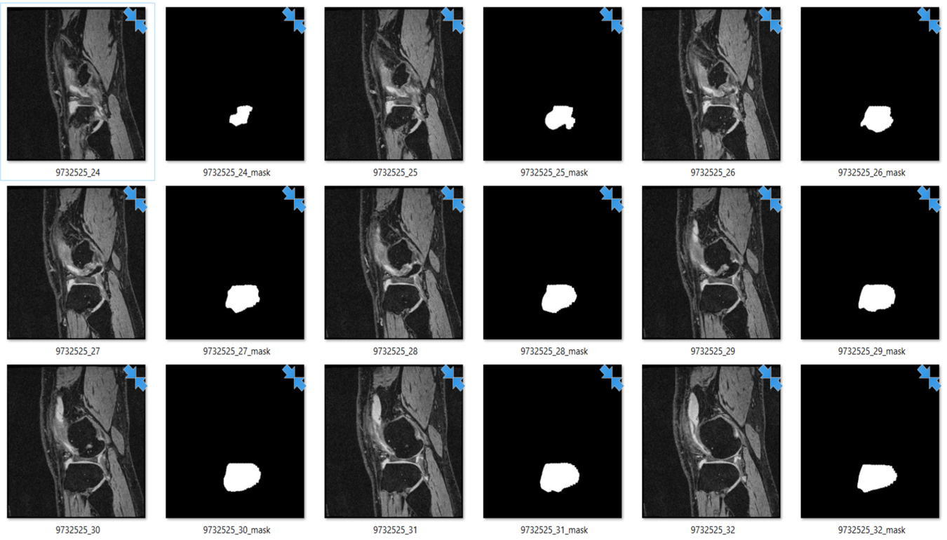 Github Nilesh7889deep Learning For Tibia Bone Segmentation Using U