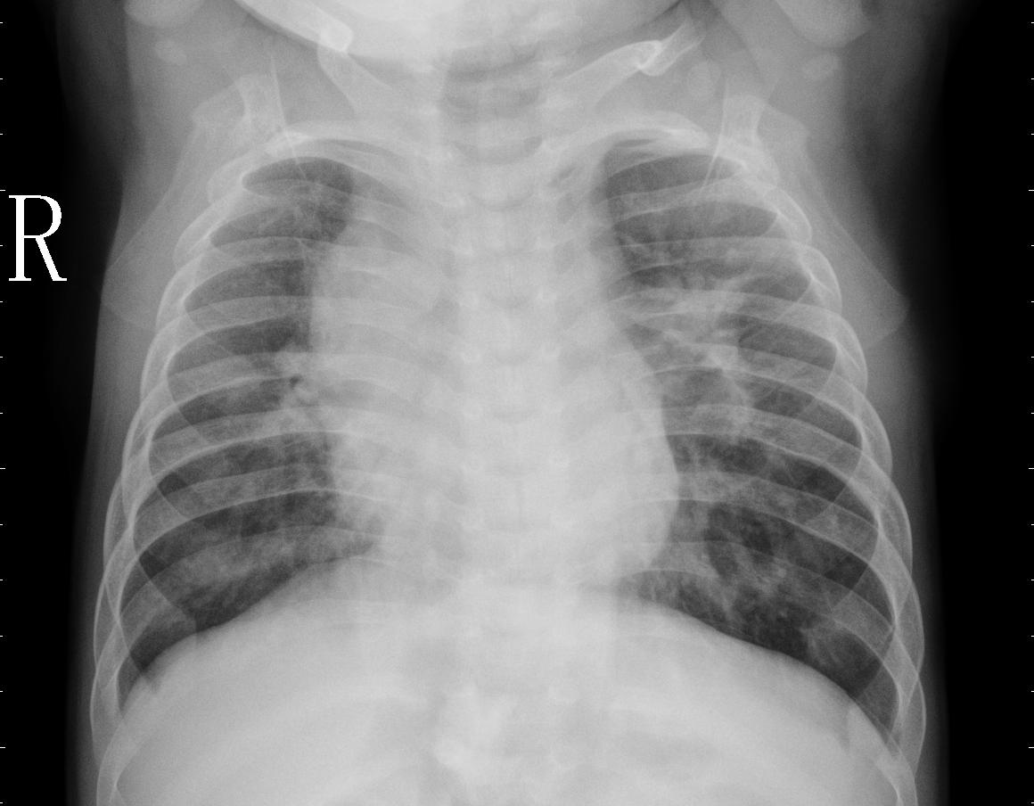 GitHub - nkcheung/Pneumonia-CXR-classification-with-CNN