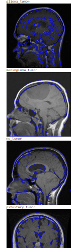 GitHub - devparikh/BrainCancerDetection: This is a project that I made using Tensorflow and ...