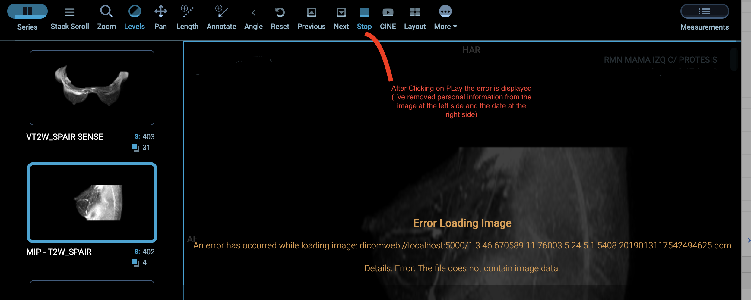 Getting an issue when displaying my JSON in the Standalone Viewer · Issue #362 · OHIF/Viewers ...