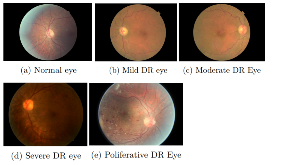GitHub - Sabarish99/Diabetic-Retinopathy-Detection
