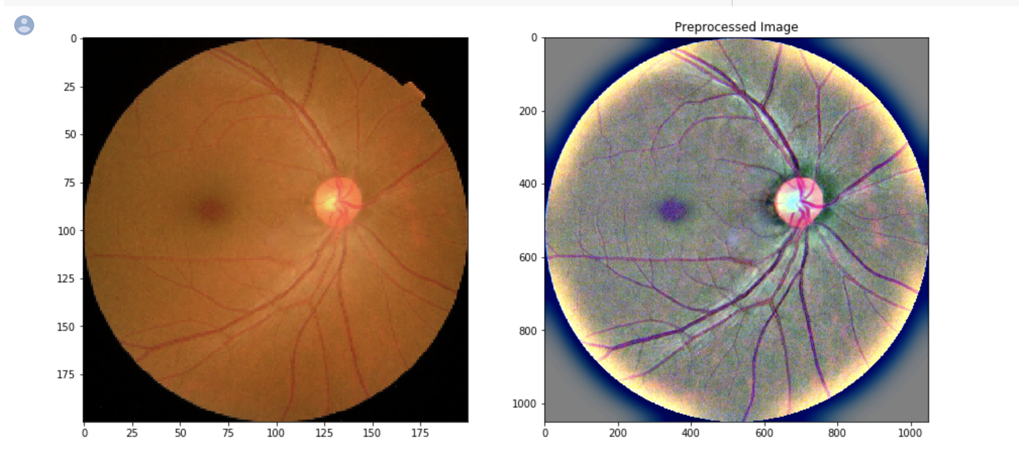 GitHub - Sabarish99/Diabetic-Retinopathy-Detection