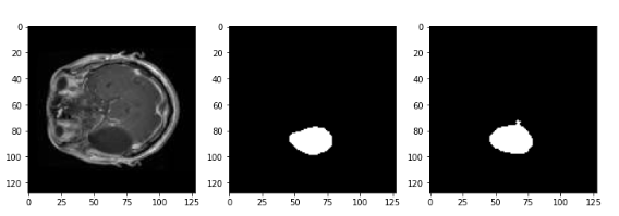 GitHub - MatteoMass/CNN-in-tumor-detection-on-MRI