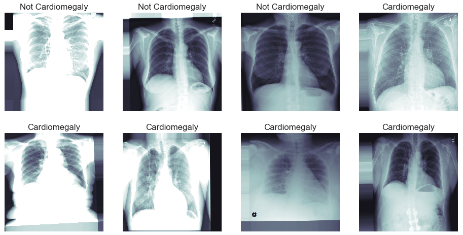 Github Jklug34 Cardiomegaly Deep Learning Image Classification