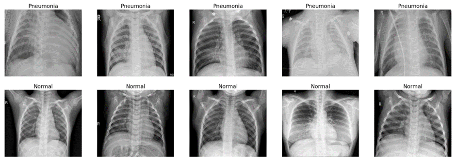 GitHub - Dhruv590/Pneumonia-Detection-on-Chest-Xrays: COEN 281 Final Project