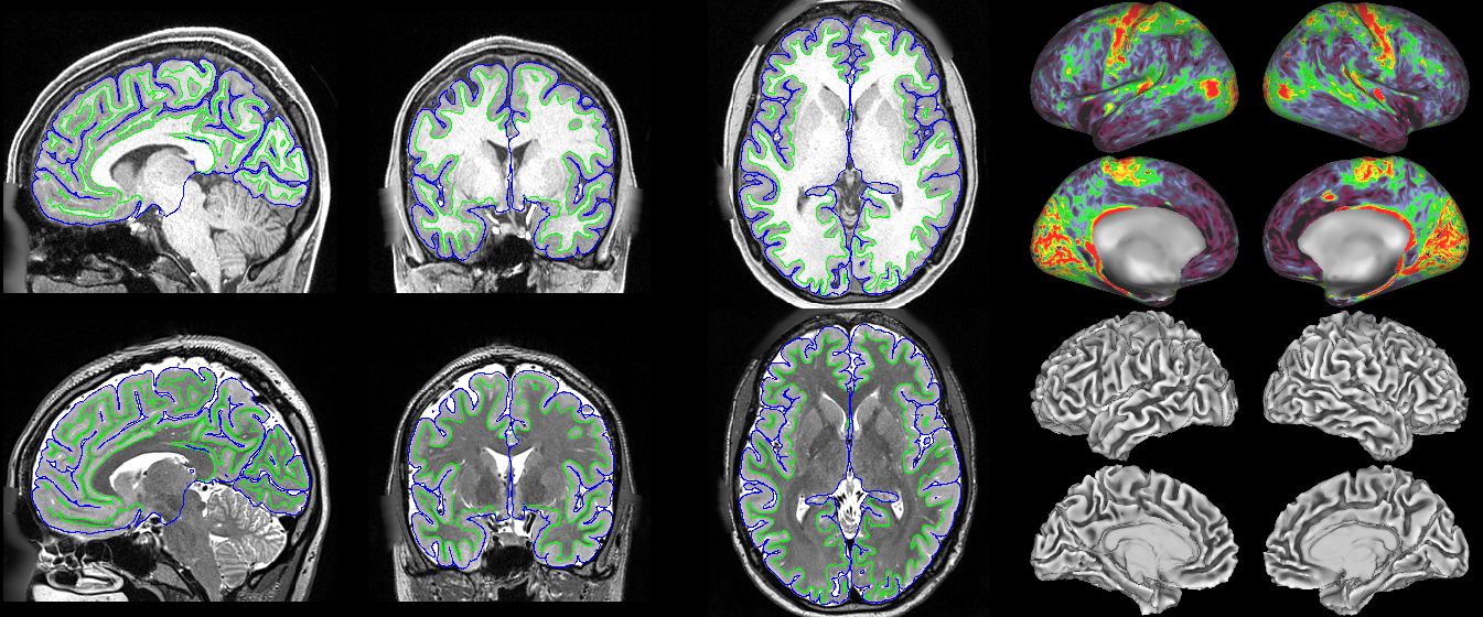 aparc.a2009s+aseg · Issue #89 · Deep-MI/FastSurfer · GitHub