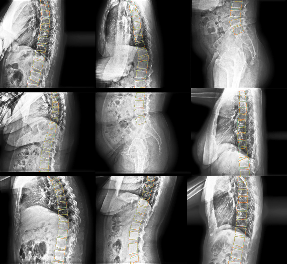 Github Limsungjoo Vertebra Segmentation Vertebra Lateral View X