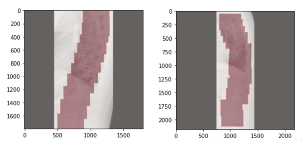 GitHub - limsungjoo/Vertebra_image_processing: Pre-processing and post-processing for Vertebra ...