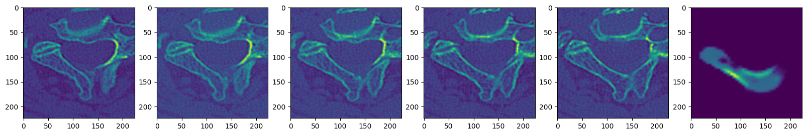 GitHub - bishnarender/rsna-2022-cervical-fracture-detection: Detection and localization of ...