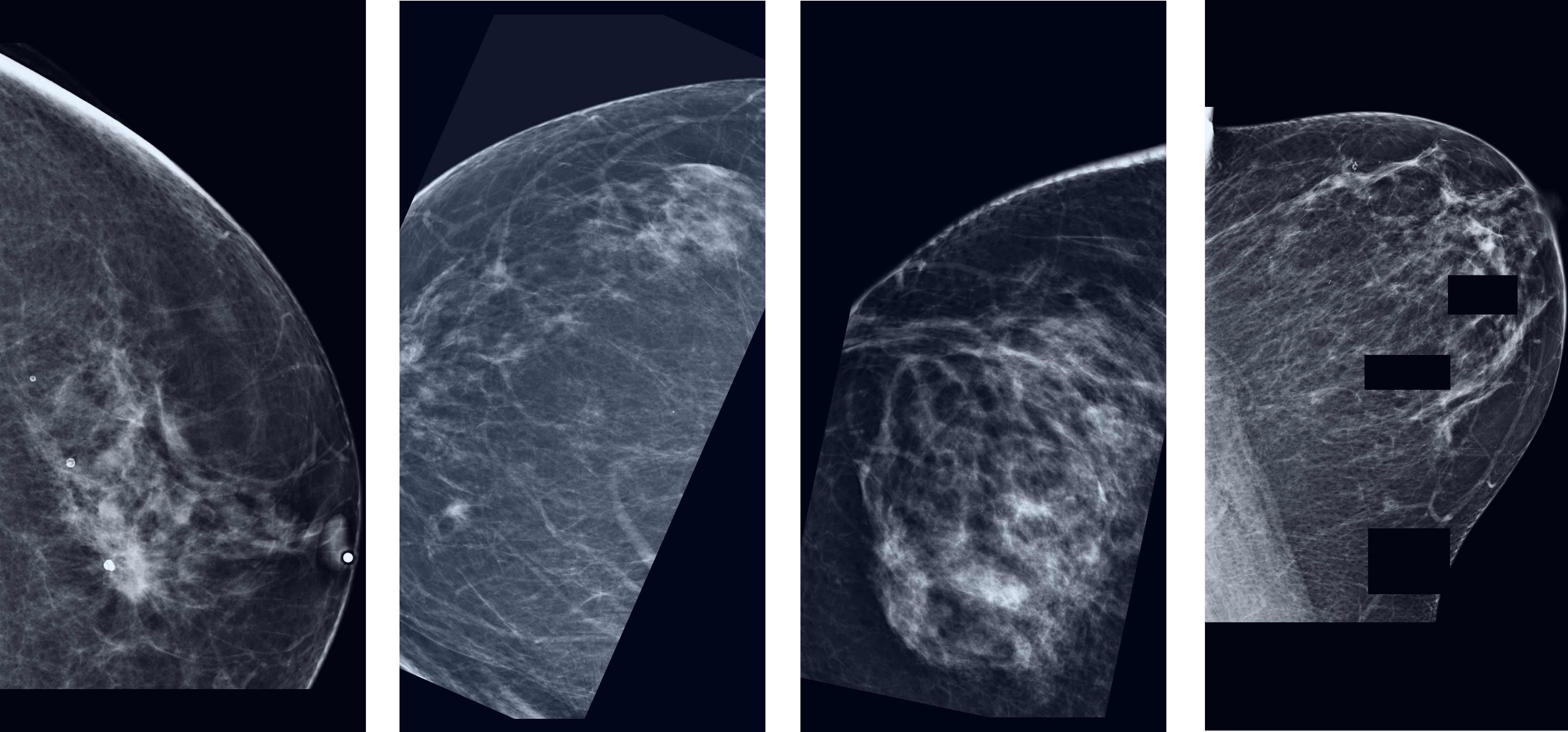 GitHub - bishnarender/rsna-screening-mammography-breast-cancer ...