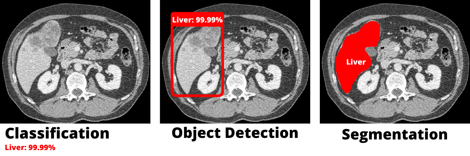 Github Aminbenmansour Automatic Liver Segmentation Using Labeled And