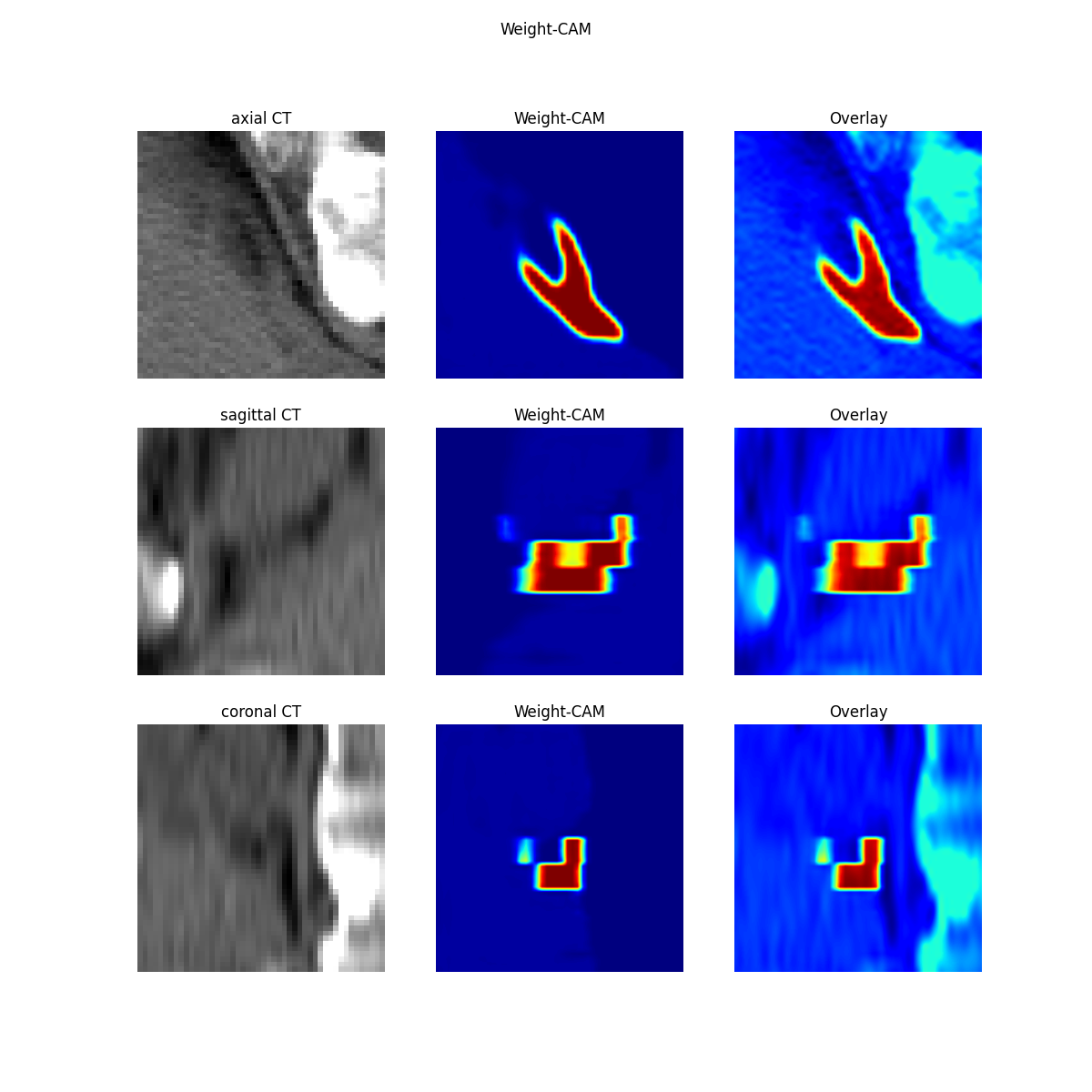 Github Kennanyang Cam Demo For 3d Medical Image Its A Cam Class Activation Mapping Demo For