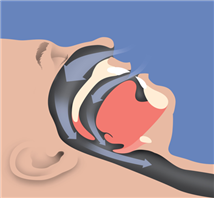 GitHub - ltgBlog/sleep_apnea