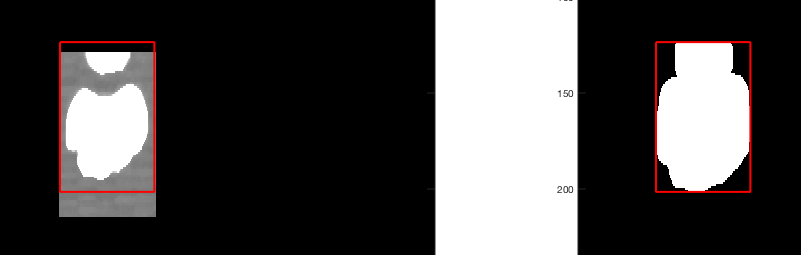 Sample FG_SNLphoto24 lost quite a lot occiptal cortex with autoROI ...