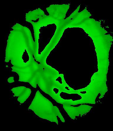 GitHub - Joshuajrodrigues/Glaucoma-detection-using-fuzzy-c-strange ...