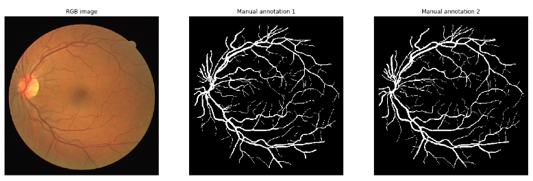 GitHub - Julio-M39/10-Segmentation_of_Retina_Vessels