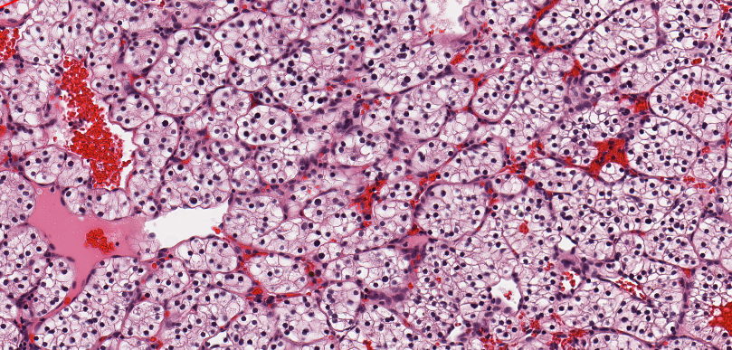 GitHub - bluewhale28/Classification-of-images-with-clear-cell-renal ...