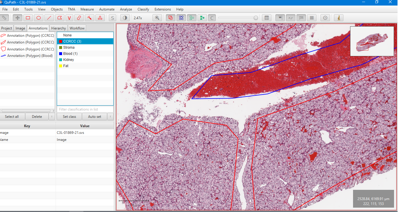 GitHub - bluewhale28/Classification-of-images-with-clear-cell-renal ...